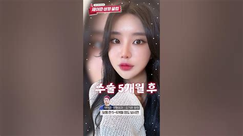 왜요 제가 안면윤곽 수술한 사람처럼 보여요 맞아요🤭 수술 전후 몰아보기 윤곽3종 Shorts 제이준 꿀팁 Youtube