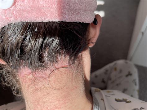 Scalp Psoriasis Looks Like This One Month After Starting Lexette Foam And Sorilux Foam
