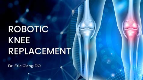 Knee Replacement Surgery Using Robotics Dr Eric Giang