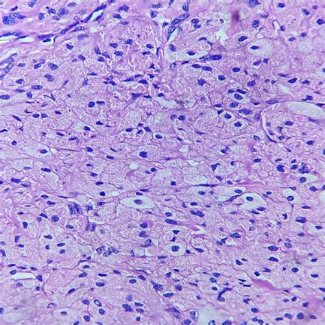 Densely Packed Cells With Abundant Pink Staining Cytoplasm With A Small Download Scientific