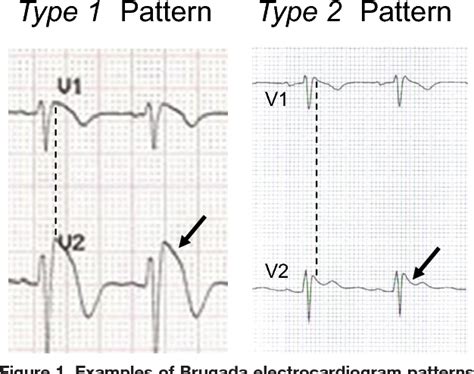 Brugada Syndrome Type 3