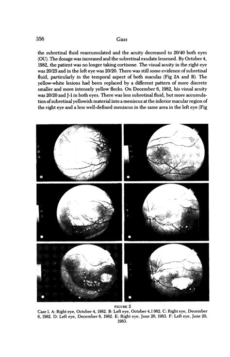 Acute Exudative Polymorphous Vitelliform Maculopathy Pmc
