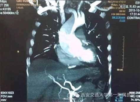 主动脉夹层瘤破裂出血抢救成功 医联