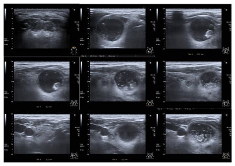 Normal Thyroid Ultrasound