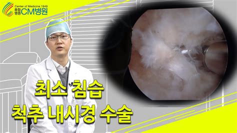 최소 침습 척추 내시경 수술 Youtube