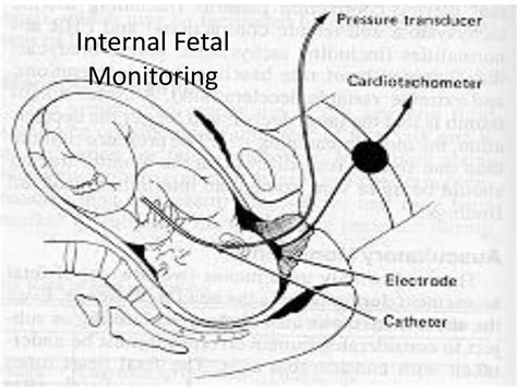 Ppt Electronic Fetal Monitoring Efm Cardiotocographyctg