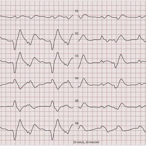 Electrocardiogram Of Case 1 In The Emergency Department Demonstrating A Download Scientific
