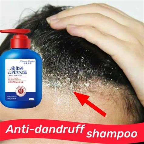 Selenium Disulfide Shampoo Kelemumur Dan Gatal Kepala Psoriasis Scalp Anti Dandruff Shampoo Selenium Disulfide Shampoo Kelemumur Dan Gatal Kepala Psoriasis Scalp Anti Dandruff Shampoo