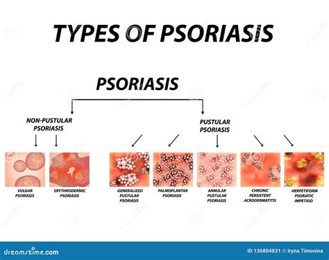 Types Of Psoriasis Pustular And Not Pustular Stock Vector
