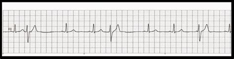 Practice Ekg Strips 402
