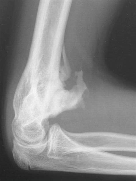 Heterotopic Ossification Pathology Orthobullets