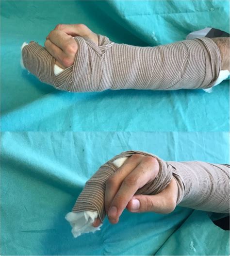 Comparison Of Functional Metacarpal Splint And Ulnar Gutter Splint In