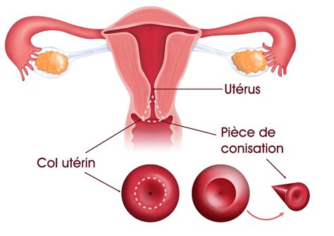 Conisation Dr Bénédicte Henry Rajeunissement Vaginal Chirurgie