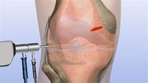 What Is Plica Syndrome