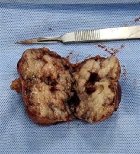 Vietnamese Medic Ultrasound Case 697 Stomach Gist Dr Phan Thanh HẢi