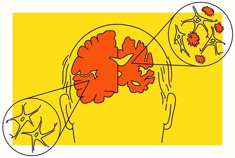 Alzheimers Disease Ad Causes Symptoms Treatments