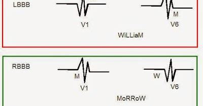 Left Vs Right Bundle Branch Block