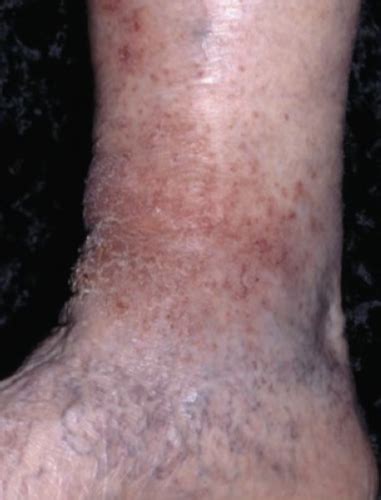 Maturation And Aging Of Integumentary System Flashcards Quizlet