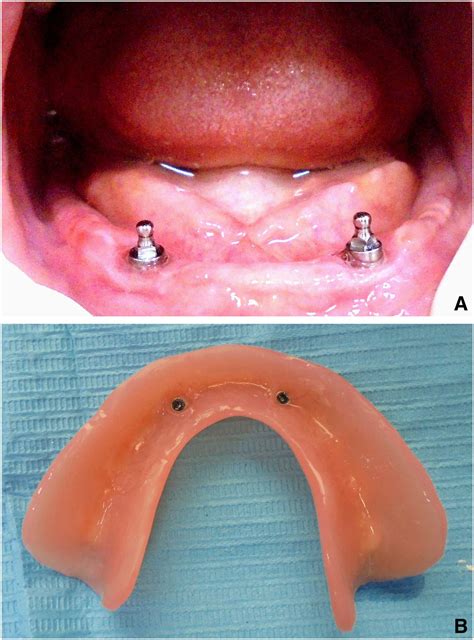 One Time Definitive Attachment Connection Versus Healing Abutment Placement For An Implant
