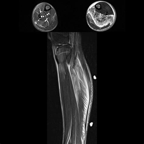 Pediatric Myositis Pediatric Radiology Reference Article Pediatric Imaging Pedsimaging