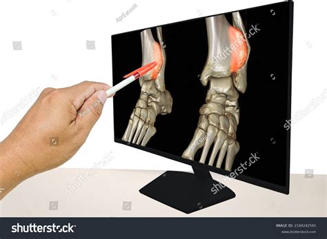 Distal Tibiofibular Joint
