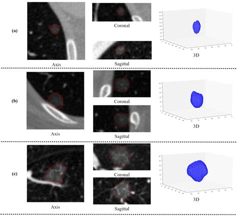 Sample Cases Illustrating Segmentation Results Of Ggo Nodules A Download Scientific Diagram