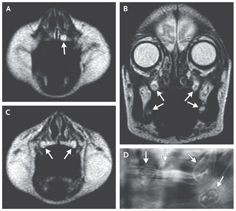 Prenatal Correction Of X Linked Hypohidrotic Ectodermal Dysplasia New England Journal Of Medicine