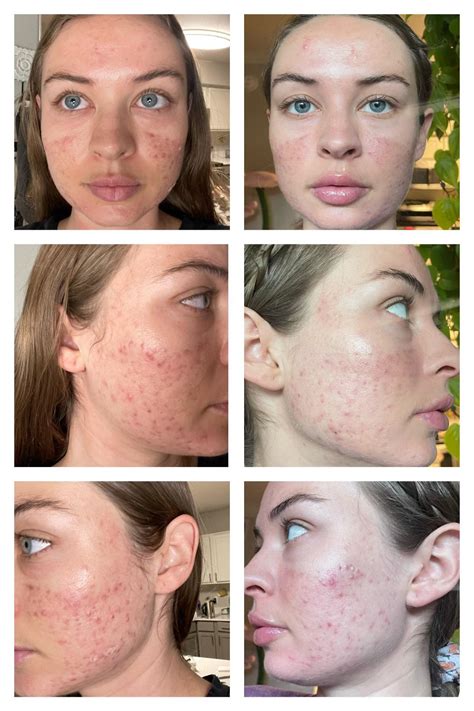 Ipledge Status Permanently Lost To Follow Up Raccutane