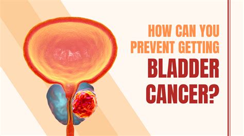 How Can You Prevent Getting Bladder Cancer Urologist Ahmedabad