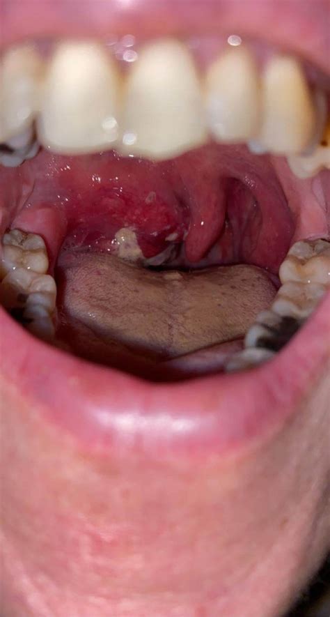 Mum Who Survived Tonsil Cancer Urges Others To Check Mouth For Signs