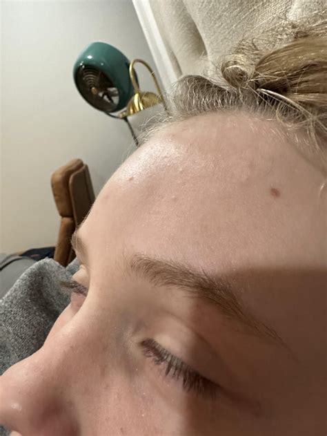 Lumps On Forehead Rsinusitis