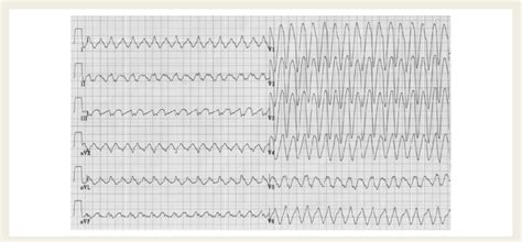Atrial Flutter With One To One Conduction In A Patient On Oral Download Scientific Diagram