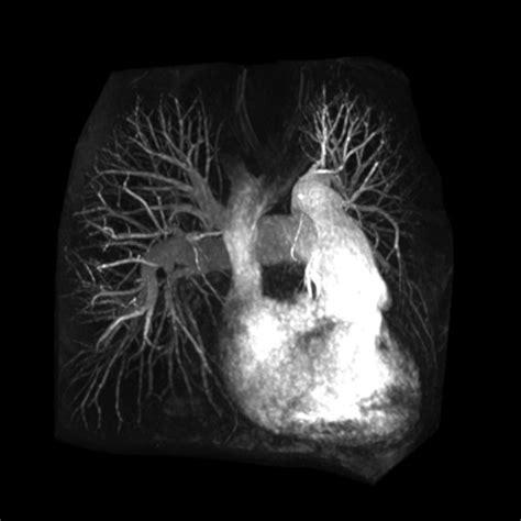 Rapid Whole Chest Ce Mra Using Parallel Imaging The Use Of Parallel Download Scientific
