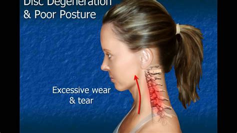 Bulging Disc Mayo Clinic Bulging Disc