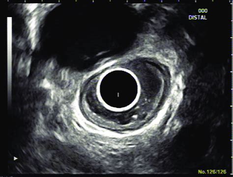 Granular Cell Tumor Esophagus