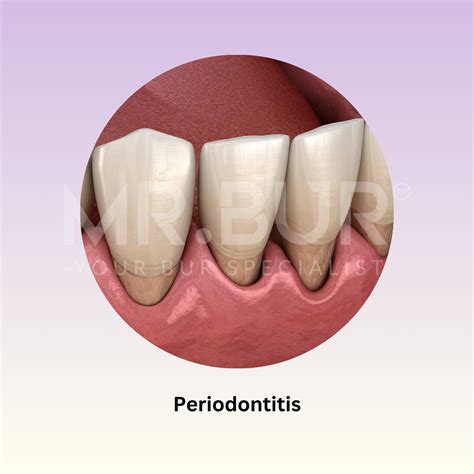 4 Key Situations Where Gingivectomy Is Essential For Optimal Oral Health Mr Bur