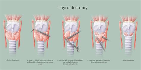 Nutrition Science Easy Learning Hyperthyroidism Part 2