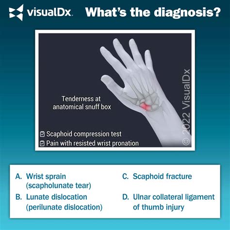 Scaphoid Examination
