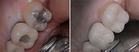 Dental Onlay Before And After Barrera Advanced Dentistry Smile Gallery
