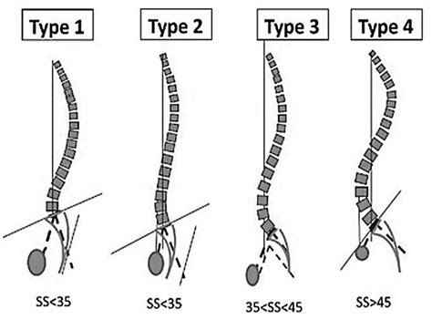 Roussouly Classification Of Spinopelvic Alignment 9 Download