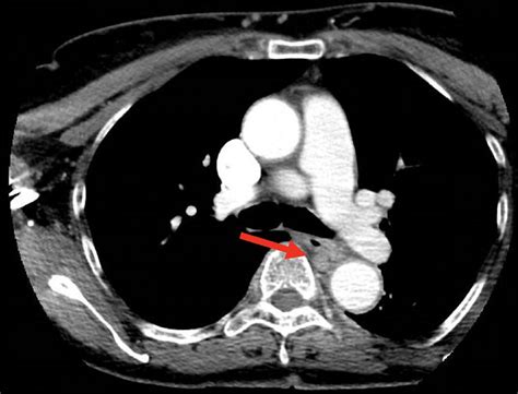 Ct Neck With Contrast Demonstrates A Mass Compressing The Esophagus At Download Scientific