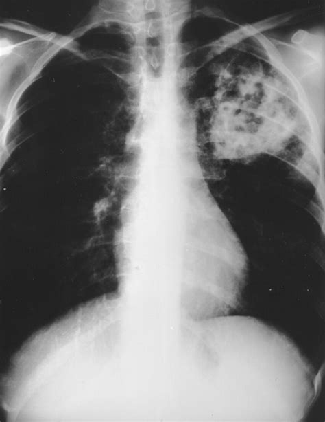 Chest X Ray Demonstrates Cavitary Pneumonia In Patient 1 Download
