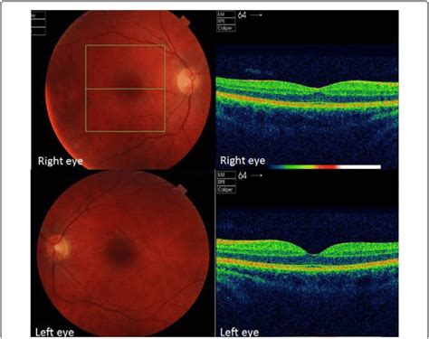 Posterior Segment Oct Showing A Complete Resolution Of The Hemorrhages