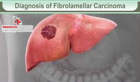 Rare Liver Cancer Understanding Fibrolamellar Carcinoma