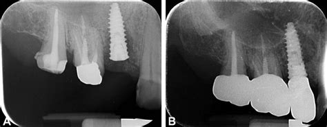 Case 5 Biological Complication Periapical Radiograph 1 Month