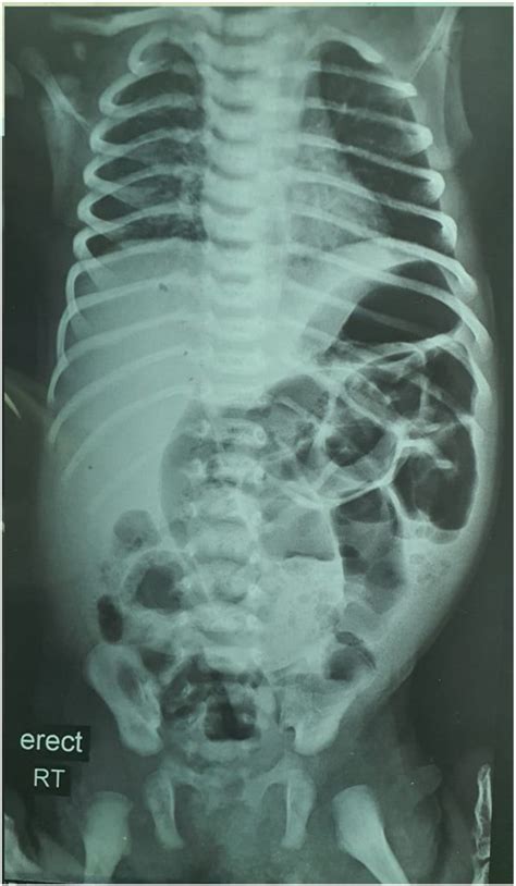 Erect Abdominal X Ray Showing Dilated Stomach And Small Bowel Loops