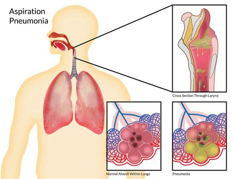 Aspiration Anatomical Definition At Albert Prowell Blog