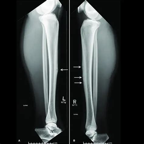 X Ray Tibia Ap And Lateral View Test Price In Delhi Ganesh Diagnostic
