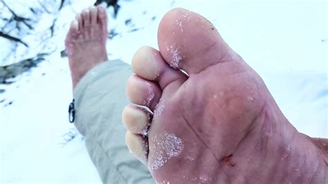 Frpzen Feet Frostbite