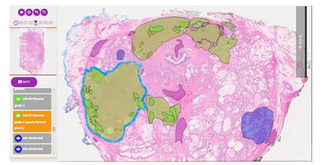 A Comprehensive Ai Model Development Framework For Consistent Gleason